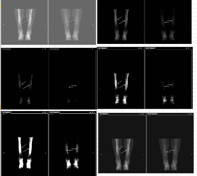 MTSS/Shin Splints/Nuclear Bone Scan Results - Thoughts? - Triathlon ...